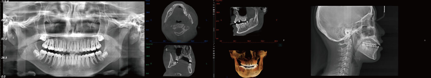 Raio-X Extra-oral 3D Meyer » P-Ortho