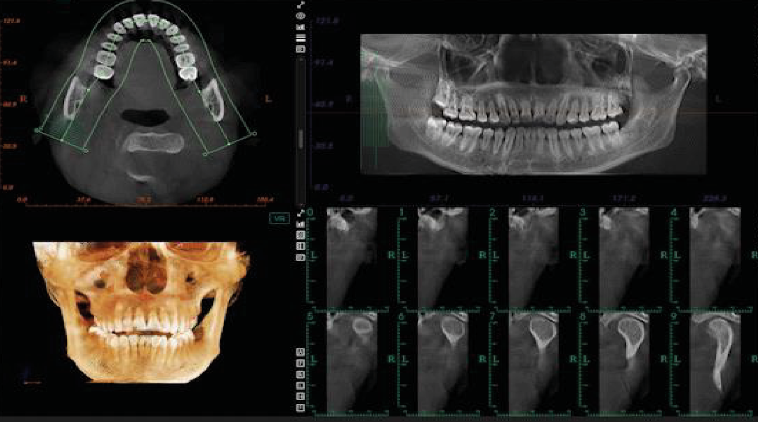 Raio-X Extra-oral 3D Meyer » P-Ortho